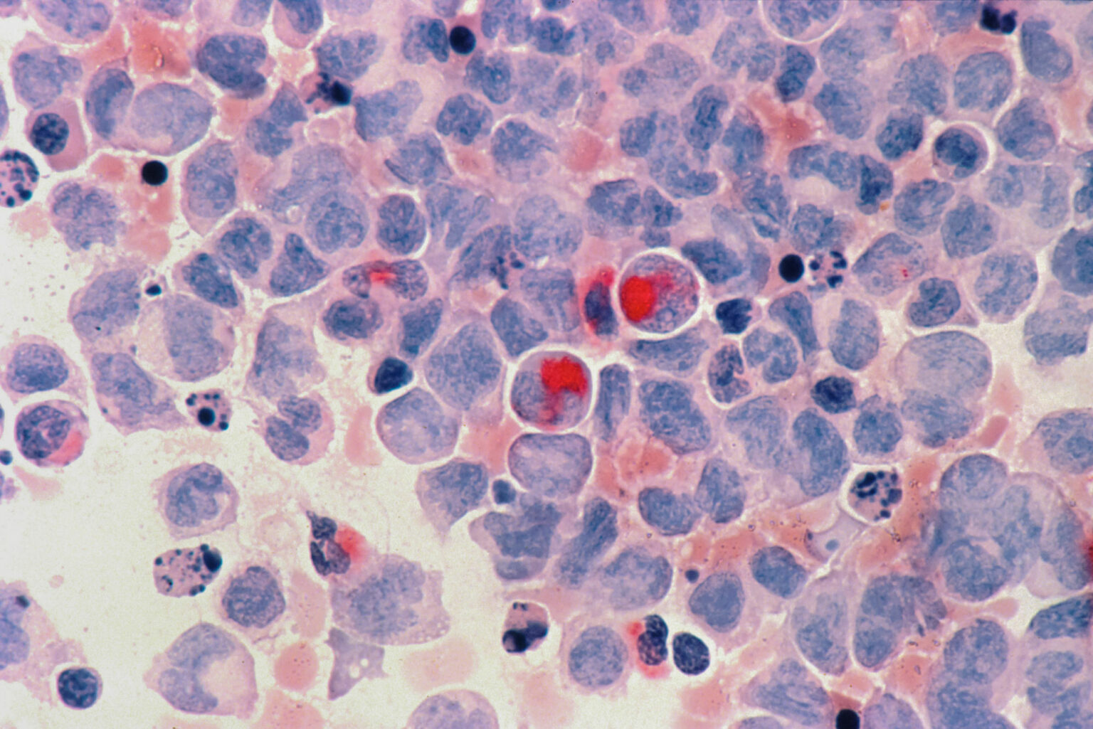 Leukaemia Types | Leukaemia UK